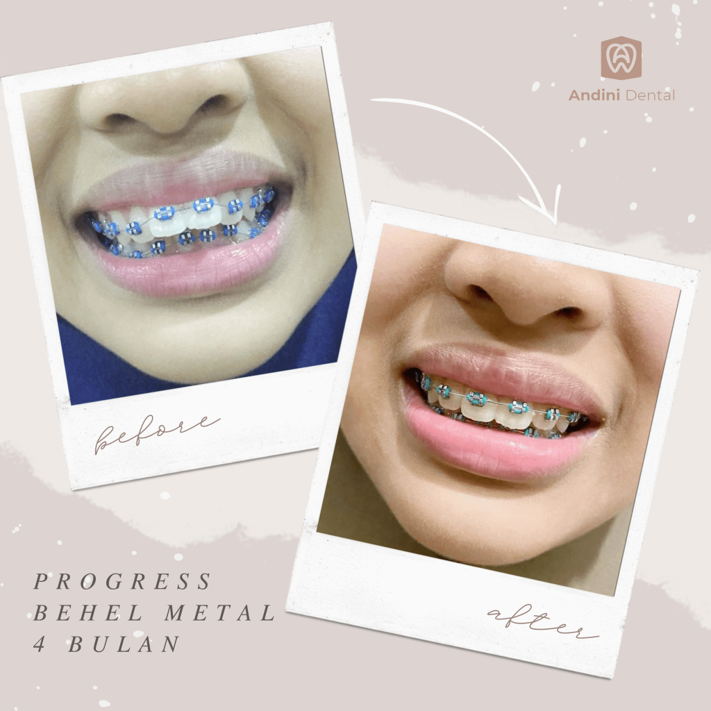 Pasang Behel/Kawat Gigi - Andini Dental Jogja